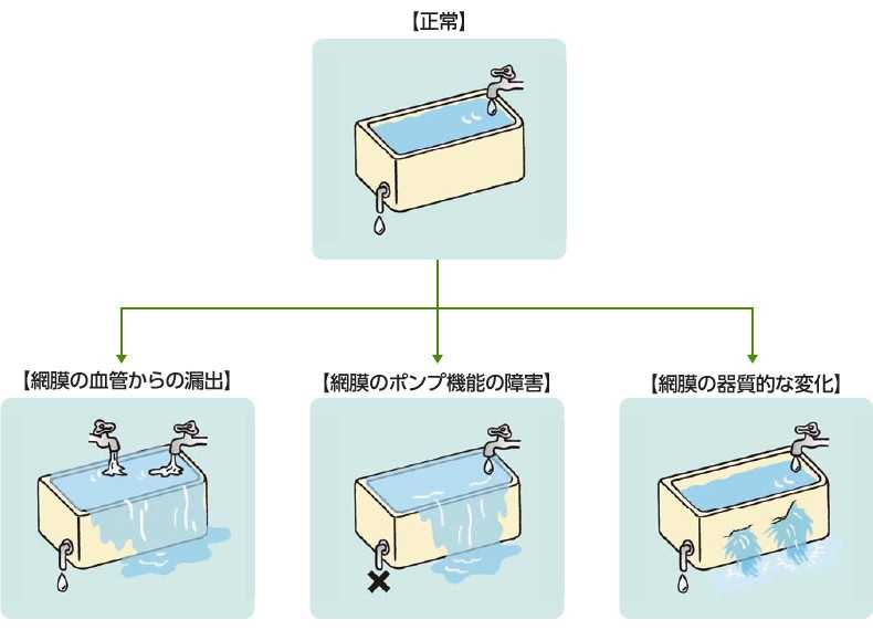糖尿病黄斑浮腫とは？ 糖尿病黄斑浮腫 網膜ドットコム ノバルティス ヘルスケア ノバルティス ファーマ株式会社