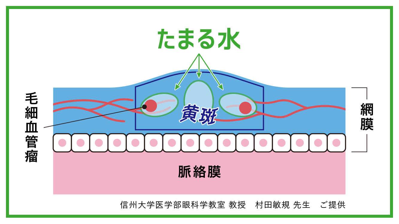 糖尿病黄斑浮腫の「たまる水」 Vision 100 網膜ドットコム ノバルティス ヘルスケア ノバルティス ファーマ株式会社