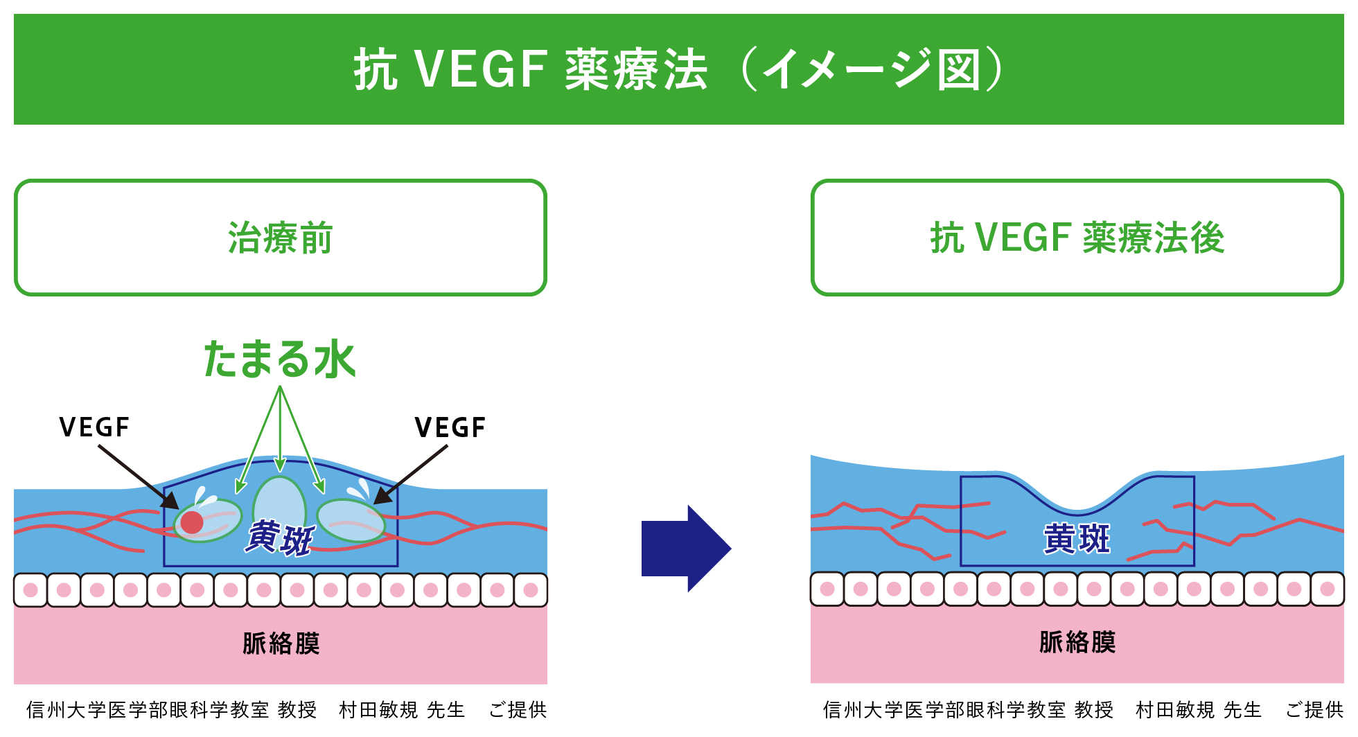 糖尿病黄斑浮腫の「たまる水」 Vision 100 網膜ドットコム ノバルティス ヘルスケア ノバルティス ファーマ株式会社