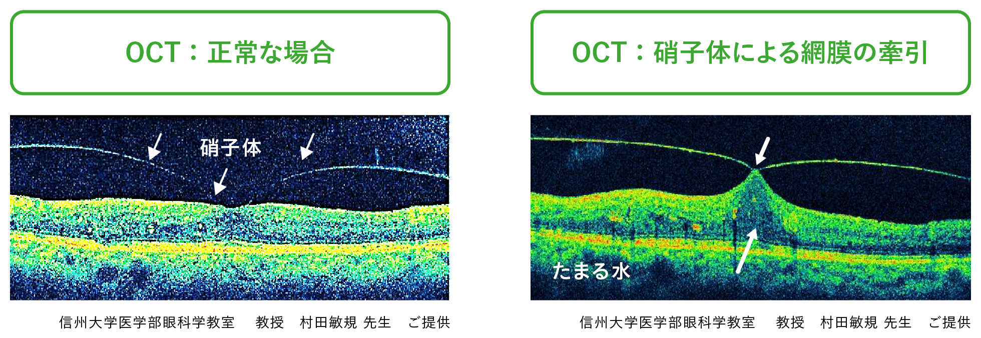 糖尿病黄斑浮腫の「たまる水」 Vision 100 網膜ドットコム ノバルティス ヘルスケア ノバルティス ファーマ株式会社