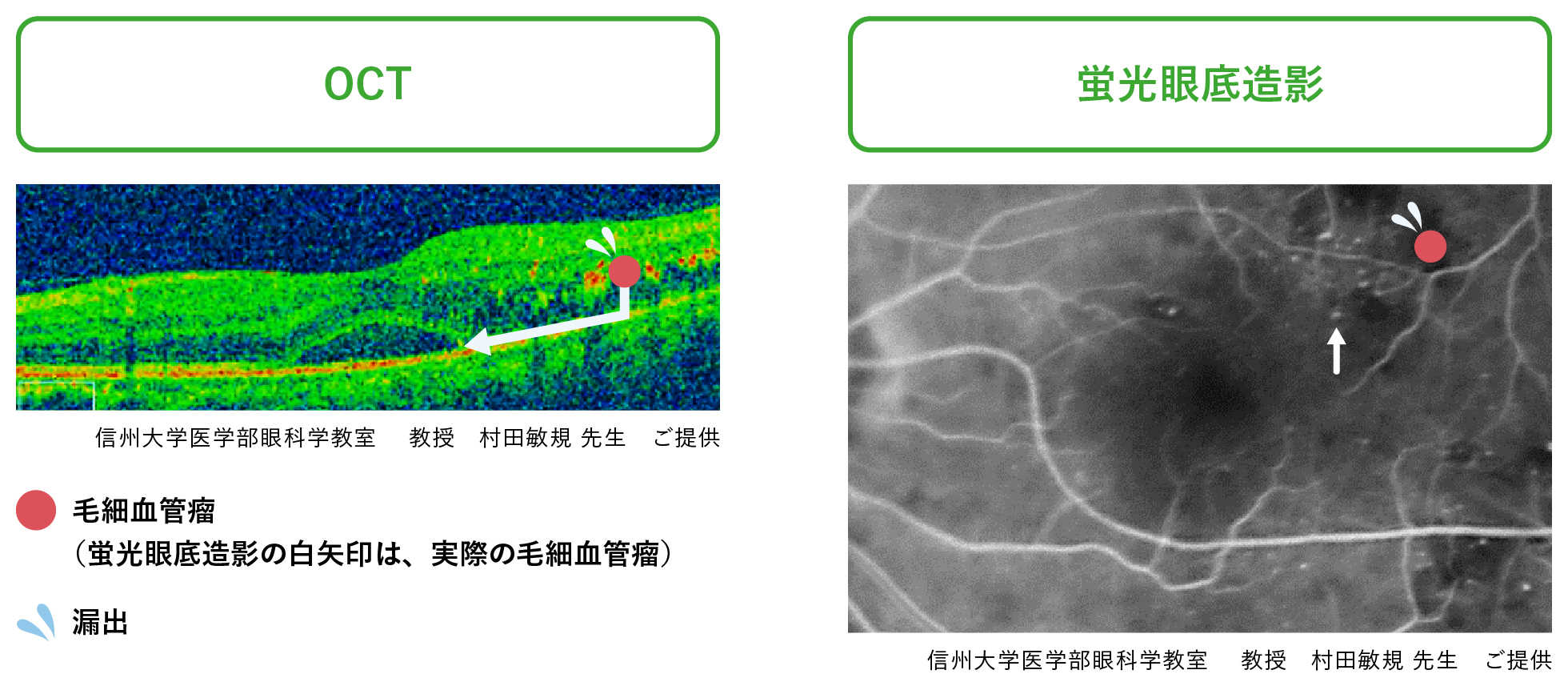 糖尿病黄斑浮腫の「たまる水」 Vision 100 網膜ドットコム ノバルティス ヘルスケア ノバルティス ファーマ株式会社